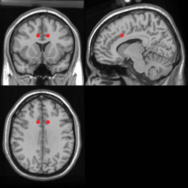 Anterior Cingulotomy for OCD | Advanced Interventions Service